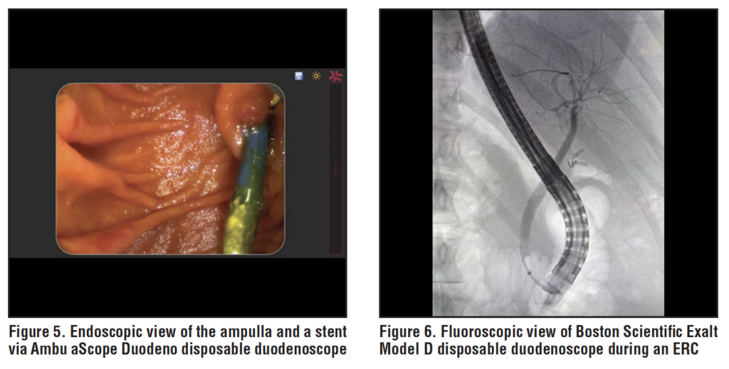 Disposable Endoscopes: Current Status and Future Directions - Practical ...