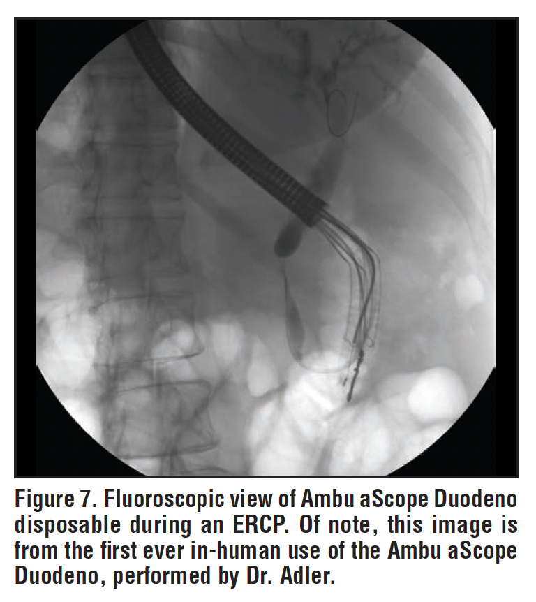 Disposable Endoscopes: Current Status and Future Directions - Practical ...