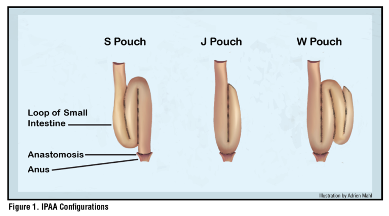 Nutrition Therapies for Patients with an Ileoanal Pouch: A Moving ...