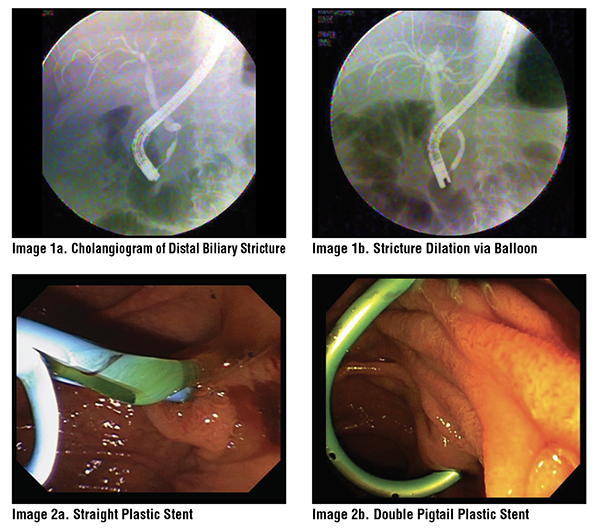 Biliary Strictures - Practical Gastro