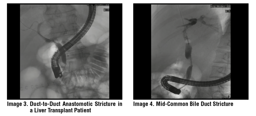 Biliary Strictures - Practical Gastro