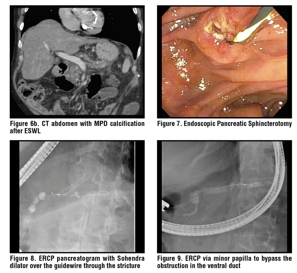 Chronic Pancreatitis - Practical Gastro