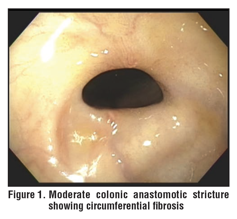 Endoscopic Management of Small Intestinal and Colorectal Anastomotic ...