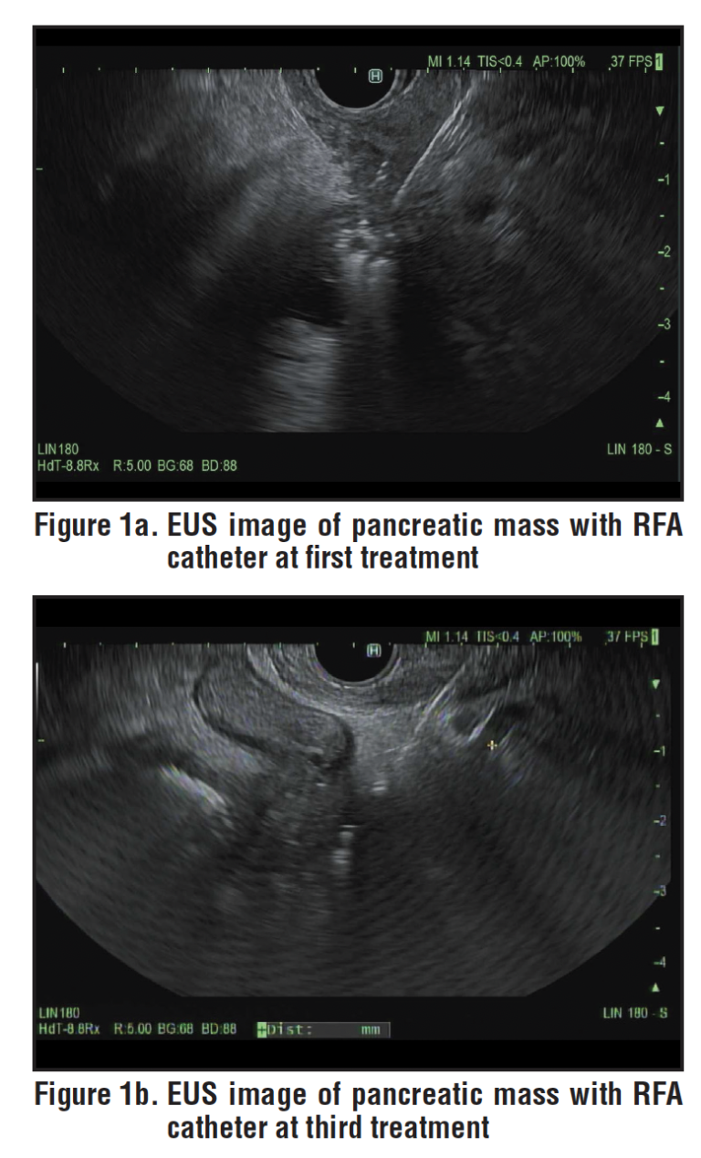 EUS-Guided Ablation Techniques for Pancreatic Lesions: A Review of ...