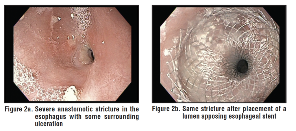 Endoscopic Management of Esophageal and Gastric Anastomotic Strictures ...