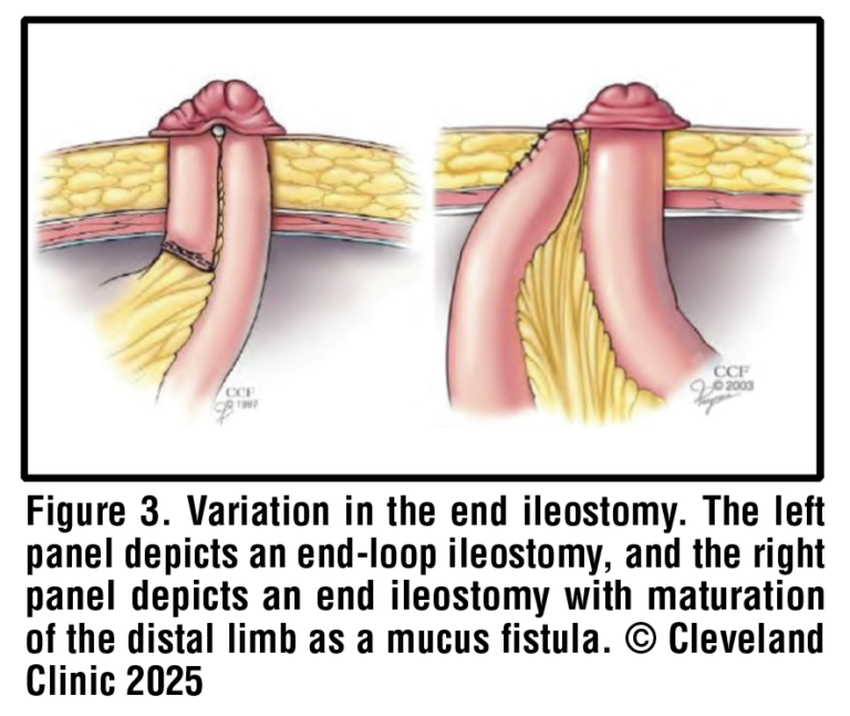 What do Gastroenterologists Need to Know About Stomas? - Practical Gastro