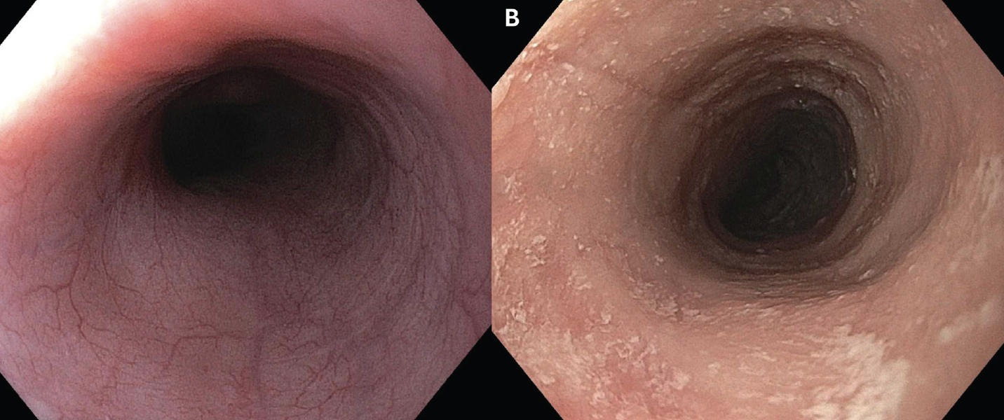 Eosinophilic Esophagitis: Tips for the Primary Care Provider ...