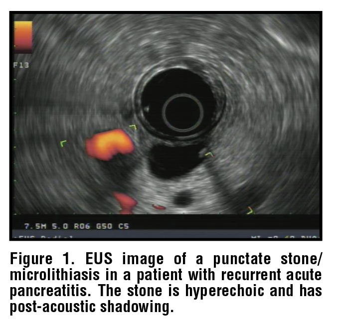 Role of EUS and ERCP in Diagnosis and Management of Idiopathic ...