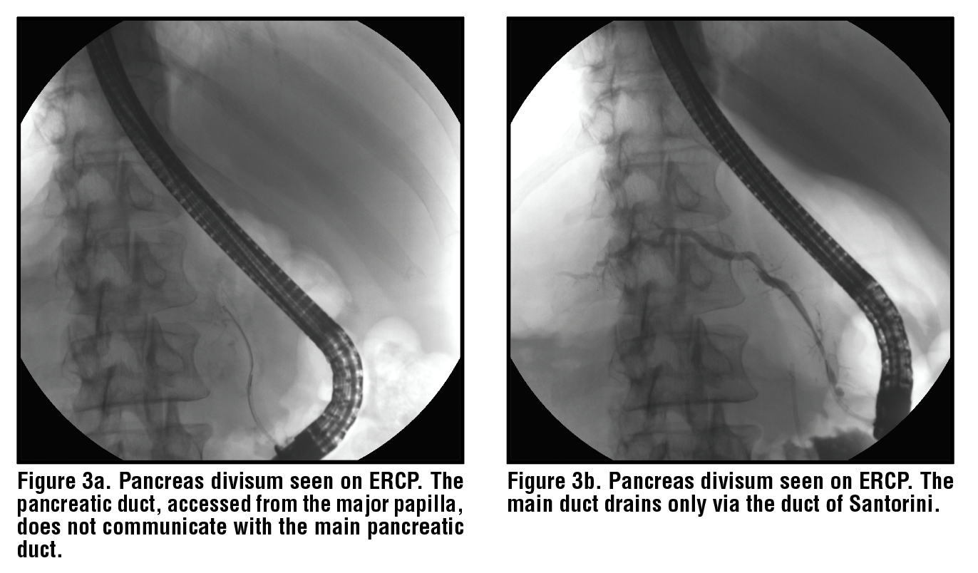 Role of EUS and ERCP in Diagnosis and Management of Idiopathic ...