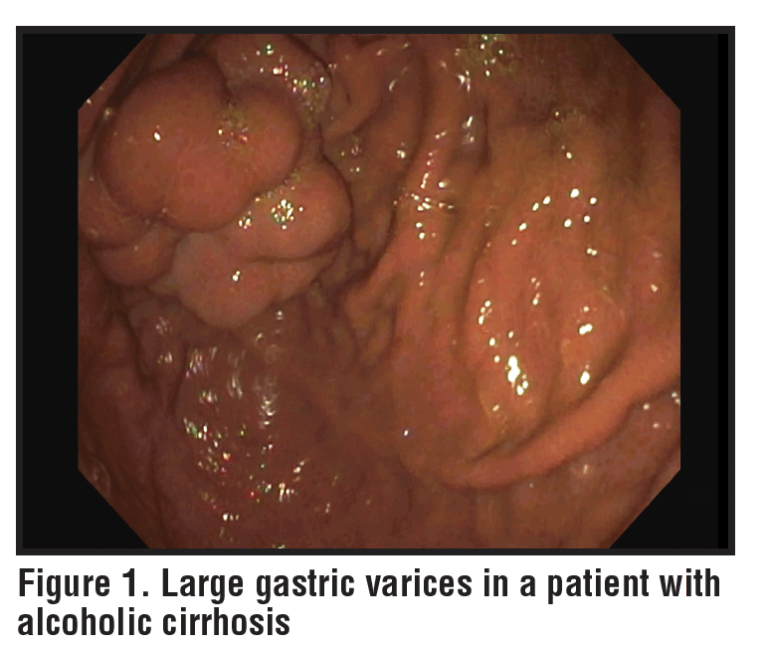 Endoscopic Ultrasound-Guided Therapy for Gastric Varices: Current ...