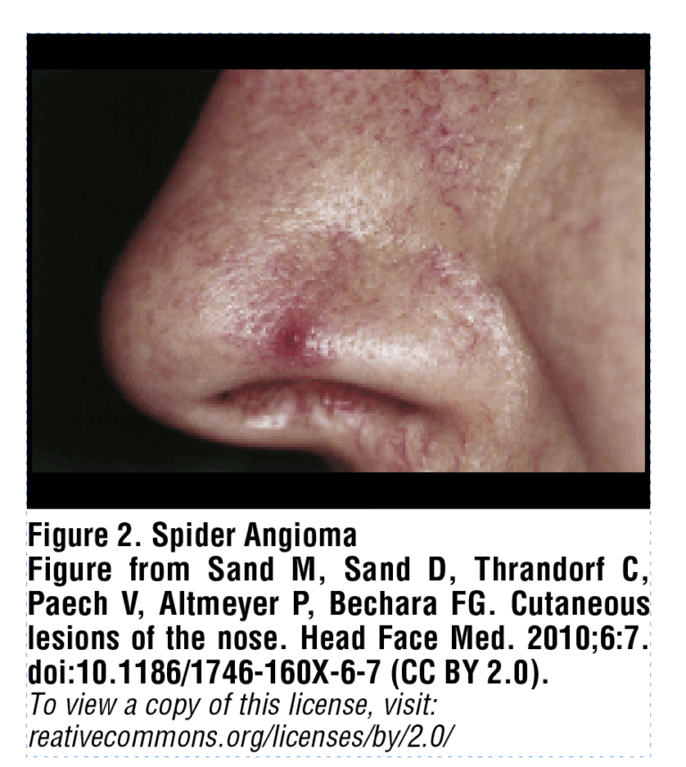 Beyond Jaundice Part 1: Identifying and Describing Cutaneous ...