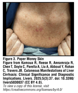 Beyond Jaundice Part 1: Identifying and Describing Cutaneous ...