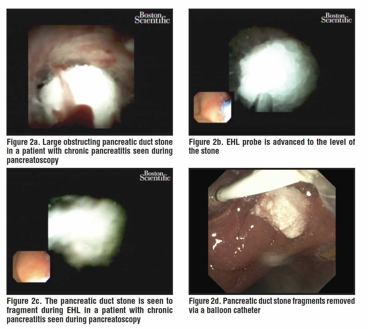 Electrohydraulic Lithotripsy for Biliary and Pancreatic Stones ...